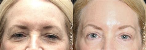 Neuromodulators 1 Refresh Dermatology