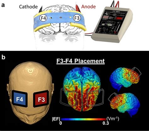 Transcranial Direct Current Stimulation