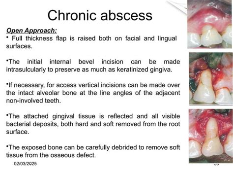 Periodontal Abscess Etiology Pathogenesis Ppt