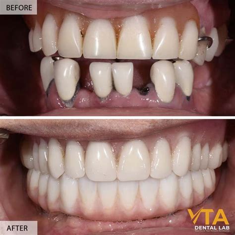 30 Dental Implant Images Before And After Vta Dental Lab