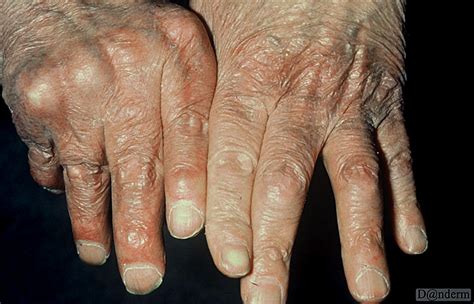 8 42 Acrodermatitis Chronica Atrophicans