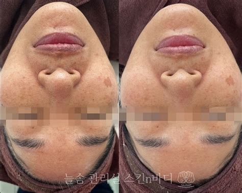서산피부관리 서산바디관리 늘솜관리실 스킨n바디케어 10년은 더 젊어진듯한 피부 단 4회차 관리만으로도 이렇게 좋아지셨어요 어두운 피부톤과 색소 고민으로 방문해