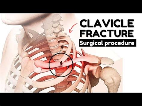 Clavicle Bone Fracture Surgical Procedure Animation Video Youtube