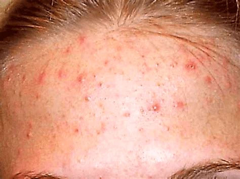 Как убрать прыщи в Фотошопе