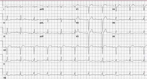Ecg Analyzer Case Studies Ai Powered Ecg Analyzer Simplified
