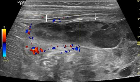 Infected Enteric Duplication Cyst Bmj Case Reports