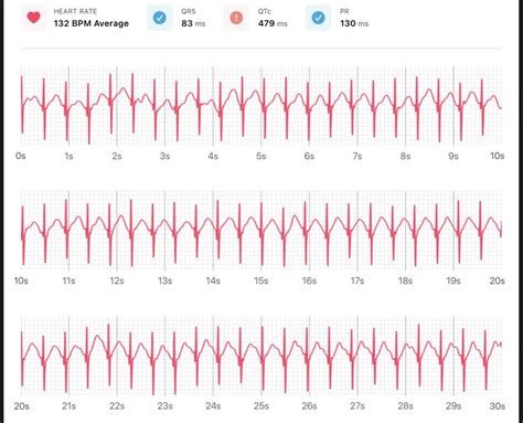 Tried To Calculate My Qt Interval But Couldnt Anyone Able To Help