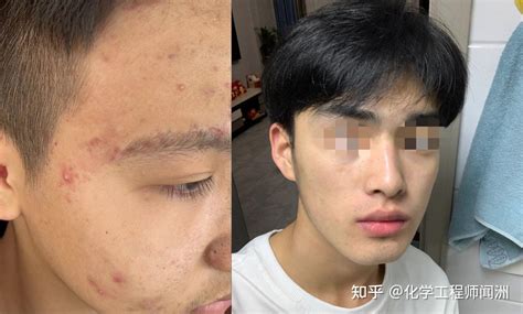 满脸痘痘皮肤又糙又黑显油腻怎么办男生如何才能快速祛痘去痘印专业配方师教你三步搞定满脸痘痘不留痘印皮肤重回清爽干净护肤小白也能看懂
