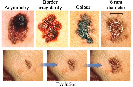 Skin Cancer Melanoma Healthlink Bc