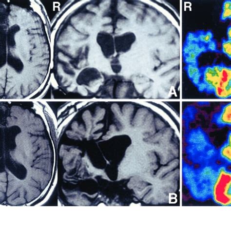 A Preoperative Electroencephalogram Eeg Showing Synchronous Spikes Download Scientific