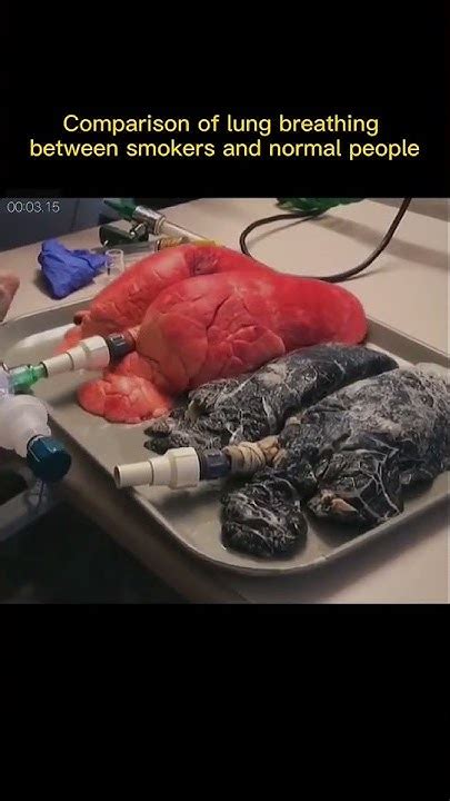 සාමාන්‍ය පුද්ගලයින් සහ දුම් පානය කරන අයගේ පෙනහළු ආශ්වාස කරන අකාරය Youtube