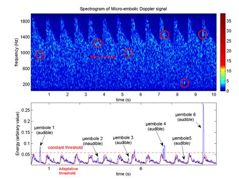 Embolus Detection With A Constant Threshold Spectrogram Top And