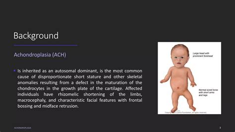 Achondroplasia Pptx
