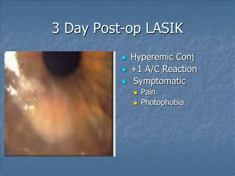 Ppt Diffuse Lamellar Keratitis Powerpoint Presentation Free Download