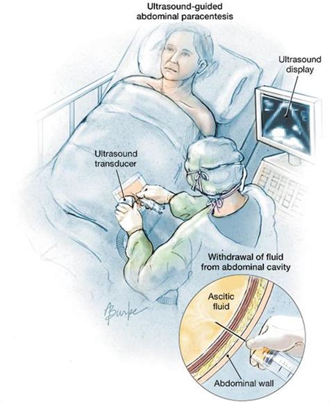Abdominal Paracentesis Patient Information Jama The Jama Network