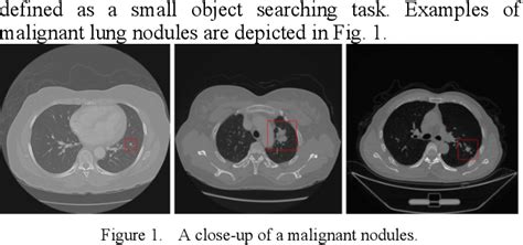 Figure 1 From Lung Nodule Detection Via 3d U Net And Contextual