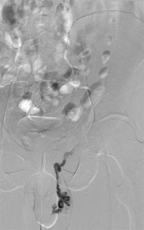 Endovascular Embolization Of Varicoceles Using N Butyl Cyanoacrylate Nbca Glue Pmc