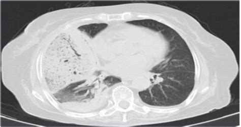 常见肺部 Ct 影像,你能识别出几个?凤凰网健康凤凰网 常见肺部 Ct 影像,你能识别出几个?凤凰网健康凤凰网