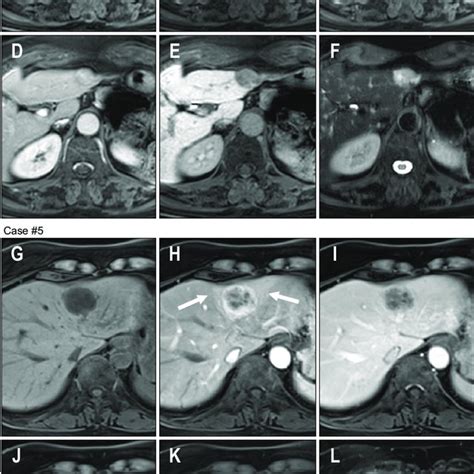 Representative Pathological Features Of Intrahepatic Cholangiocarcinoma Download Scientific