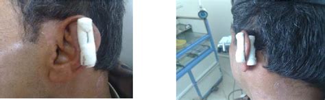 [pdf] Treatment Of Auricular Hematoma Using Dental Rolls Splints