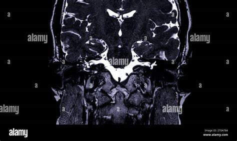 MRI Scan Of The Internal Auditory Canal IAC Stock Photo Alamy