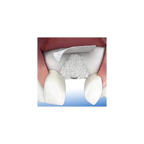 Bone Graft Dental Membrane Datum Dental Ossix Bone Resorbable Barrier