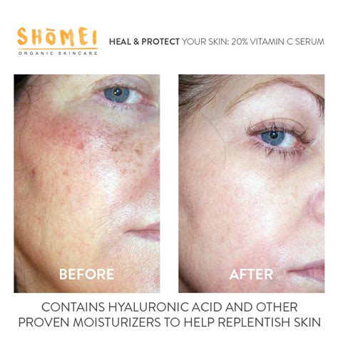 Hyaluronic Acid And Vitamin C Serum Before And After At Martha Holt Blog