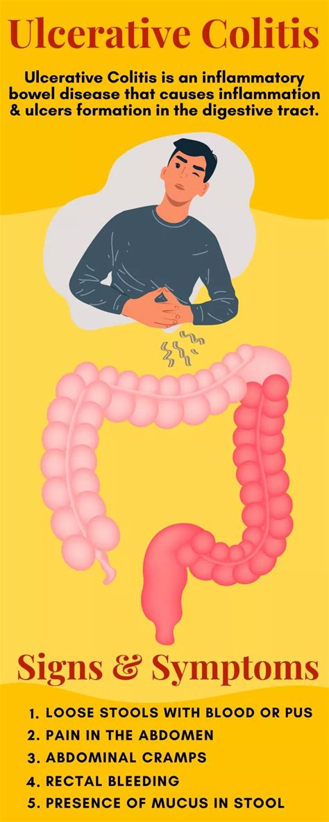 Ppt Signs Symptoms Of Ulcerative Colitis Powerpoint Presentation Id