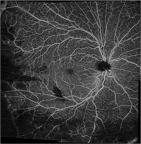 Widefield Montage Swept Source Optical Coherence Tomography Angiography Download Scientific