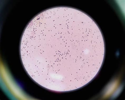 What Causes Watery Semen Cooper Clinic