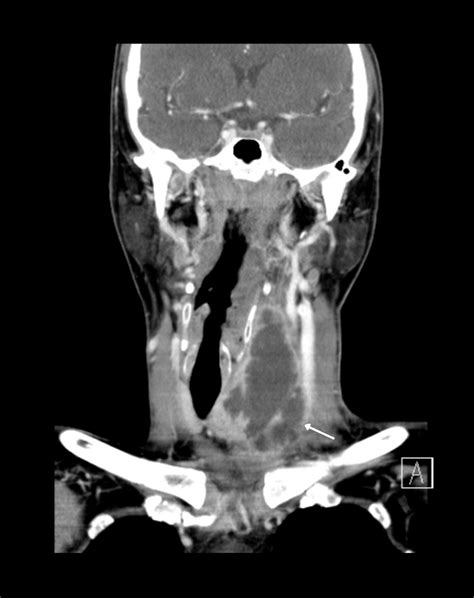 Thyroid Abscess Associated With Pyriform Sinus Fistula Mayo Clinic