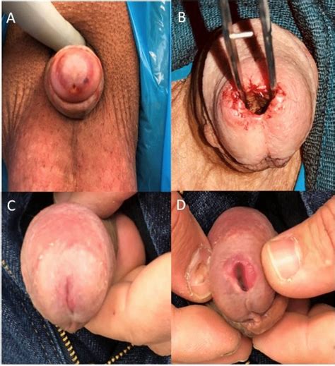 A Representative Example Of A Patient With A Fossa Navicularis