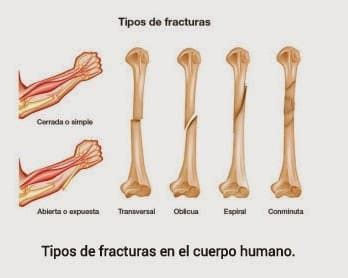 Lesiones óseas Tipos Causas Y Tratamientos Camde