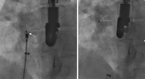 8 A The Ceraflex Septal Occluder Has A Unique Delivery System With Download Scientific Diagram