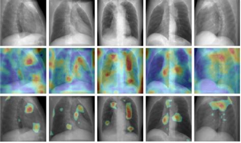 Figure G The Result Of Lesion Tuberculosis Visualization After Download Scientific Diagram