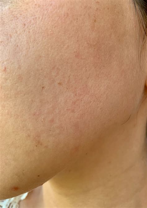 Розовые пятна на лице Вопрос дерматологу 03 Онлайн