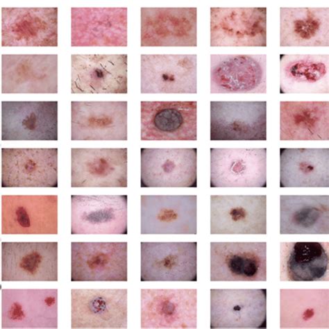 Skin Cancer Dataset Kaggle
