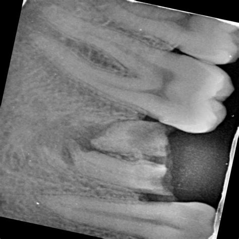 Dentalxraydetection Object Detection Dataset And Pre Trained Model By Sagar