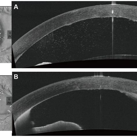 Anterior Segment Optical Coherence Tomography As Oct Shows The Download Scientific Diagram