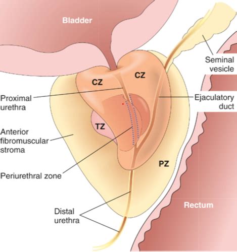 Pathology Prostate Flashcards Quizlet