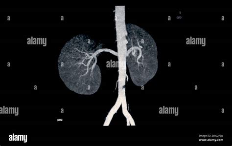 Cta Renal Artery 3d Is A Medical Imaging Procedure Using Ct Scans To