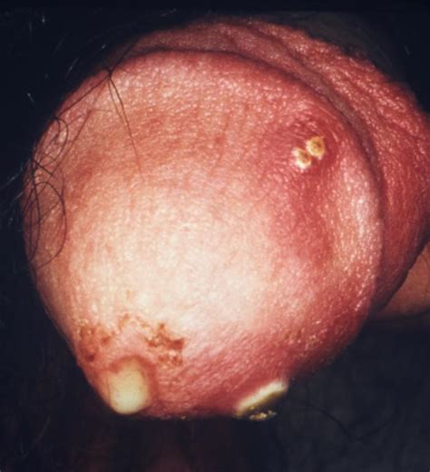 Penile Discharge Wikipedia