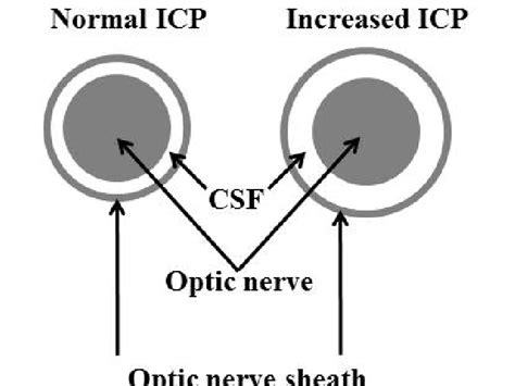 Subarachnoid Space Csf