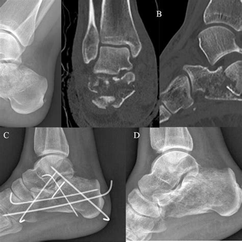 Mini Open Approach And K Wire Fixation A Pre Operative Radiographs Download Scientific