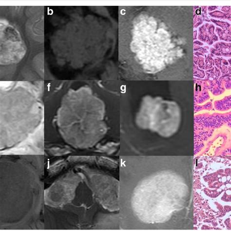 Drugs That May Influence Csf Production At Choroid Plexus Level And Download Table