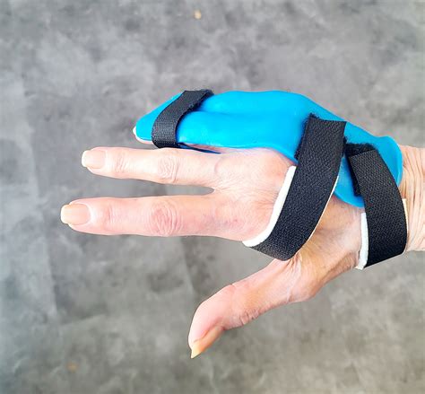 Check Out This Custom Made Thermoplastic Hand Based Ulnar Gutter Splint To Correct Deformities