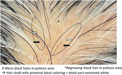 Achieving Sustained Hair Repigmentation In Poliosis Circumscripta