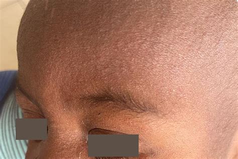 The Measles Tìm Hiểu Về Bệnh Sởi Triệu Chứng Cách Phòng Ngừa Và Điều Trị
