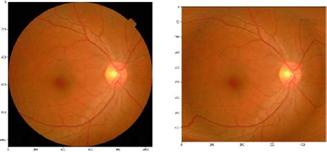 Figure 2 From Deep Learning Based Smart Iot Health System For Blindness Detection Using Retina
