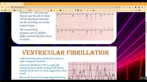 Siamese Convolutional Neural Network For Heartbeat Classification Using Limited 12 Lead Ecg